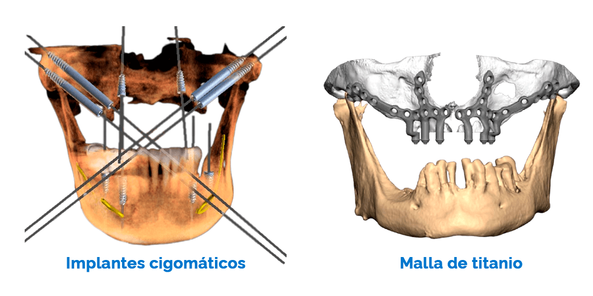 La atrofia maxilar severa y cómo la malla de titanio puede ayudar a ...