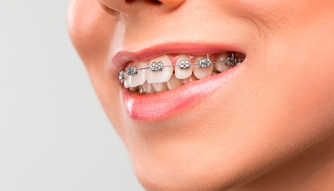 ¿Qué se puede comer después de ponerse brackets? – IMED Dental